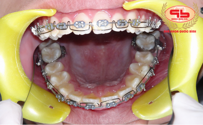 Braces system in orthodontic treatment