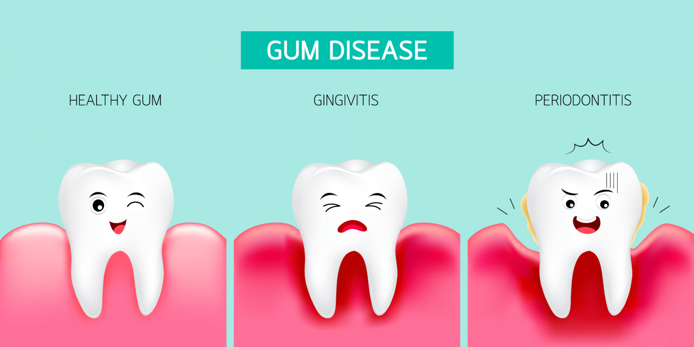 Signs of gingivitis easy to identify and the prevention.