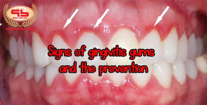 Signs of gingivitis easy to identify and the prevention.