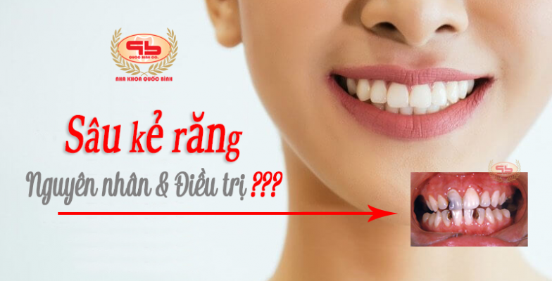 Sâu kẻ răng và điều trị hiệu quả như thế nào?
