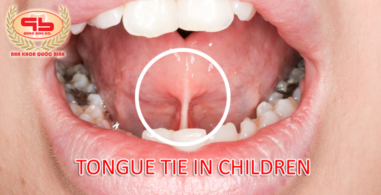 Things To Know When Children Have Tongue Tie Condition
