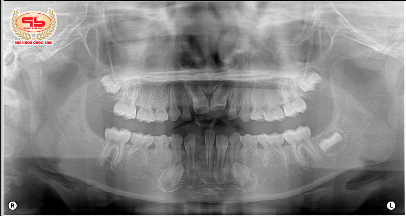 Shortage of permanent teeth and how to fix it