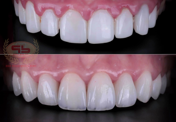 Một số cách điều trị hiệu quả tình trạng viêm nướu sau khi làm răng sứ